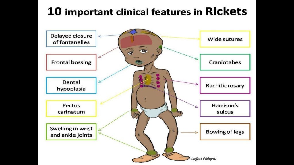 Rickets in children
