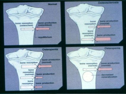 Rickets_Metabolic_Bone_Diseases.ppt