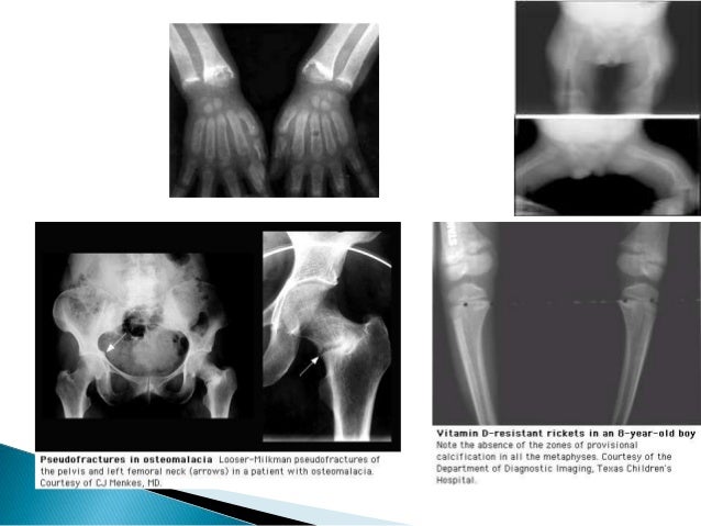Rickets_Metabolic_Bone_Diseases.ppt