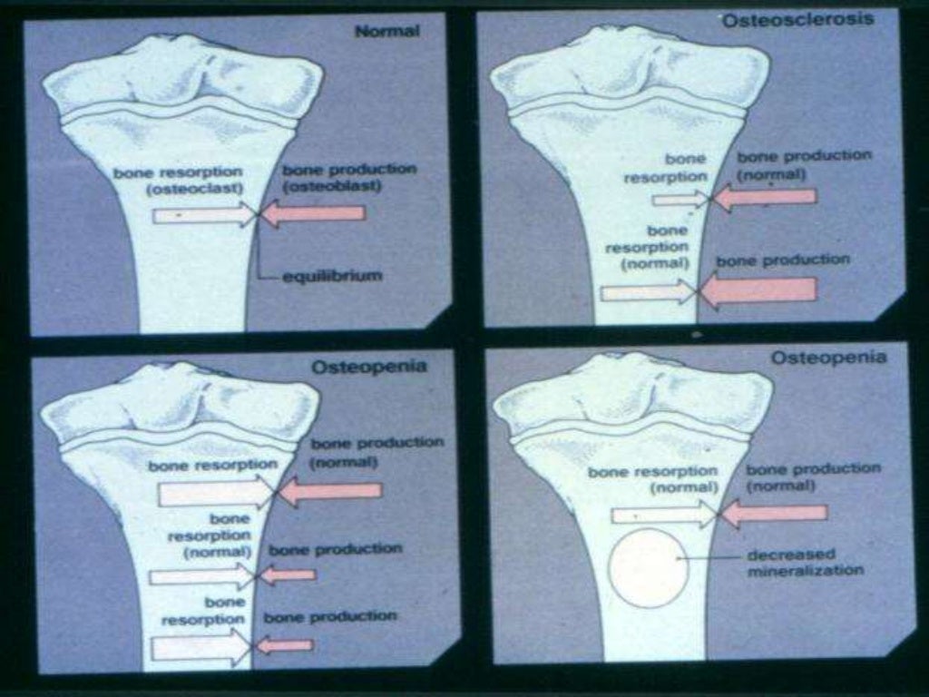 Rickets_Metabolic_Bone_Diseases.ppt