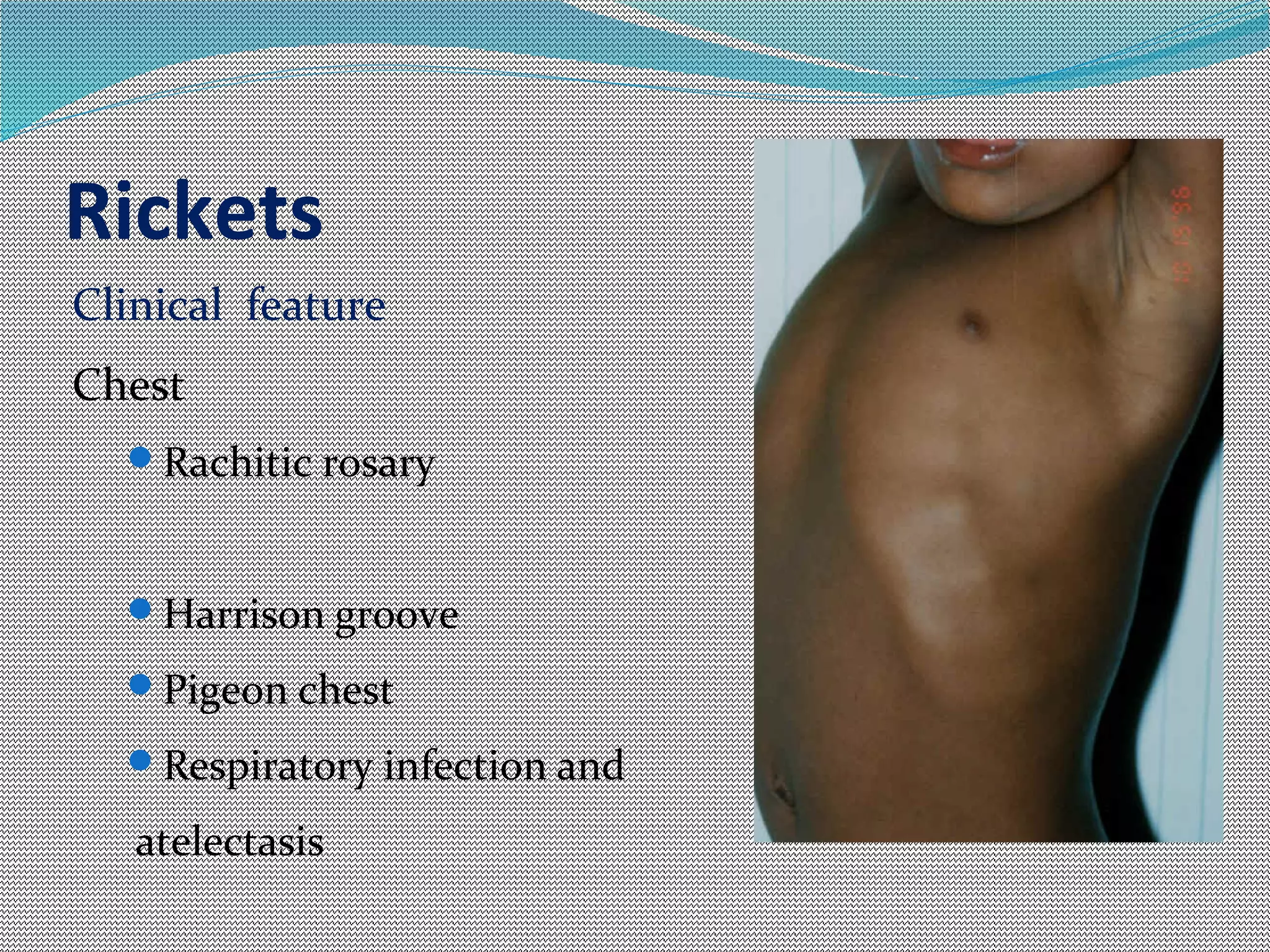Rickets & osteomalacia | PPT