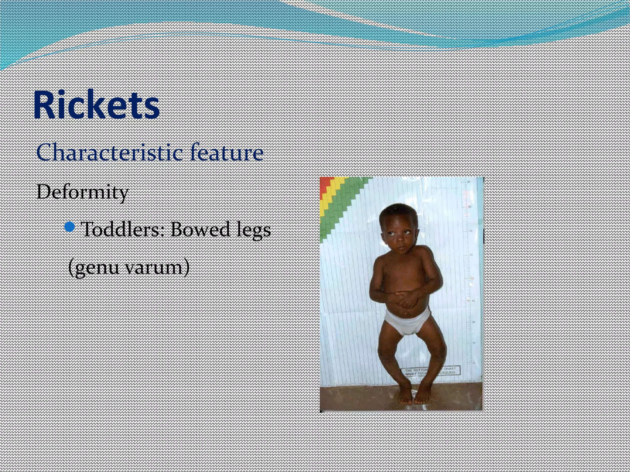Rickets & osteomalacia | PPT