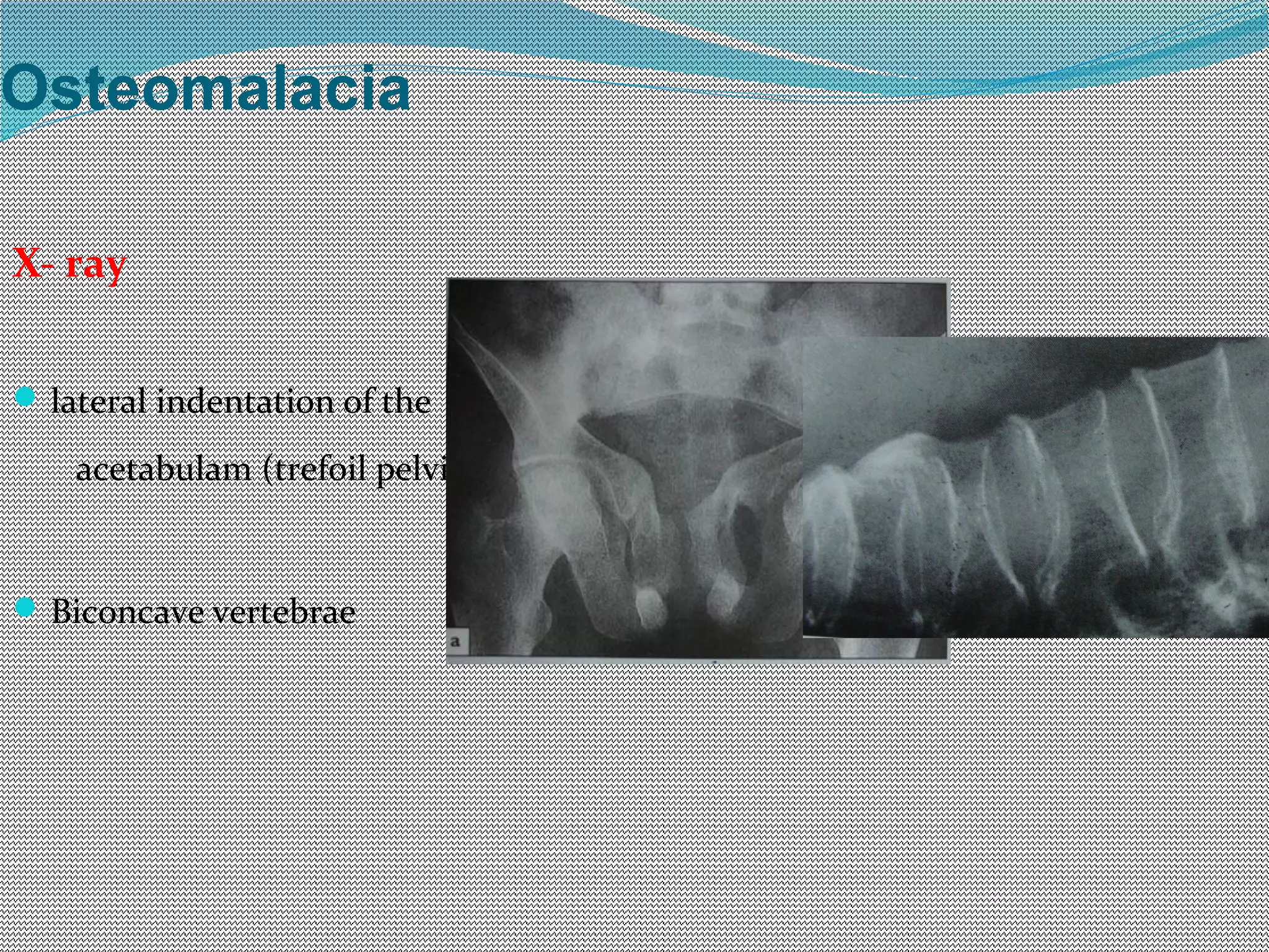 Rickets & osteomalacia | PPT