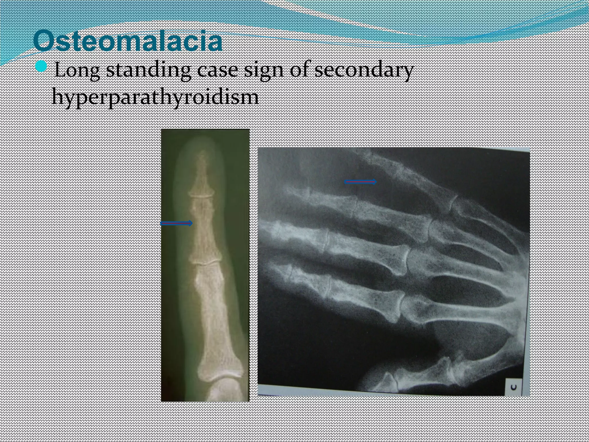 Rickets & osteomalacia | PPT