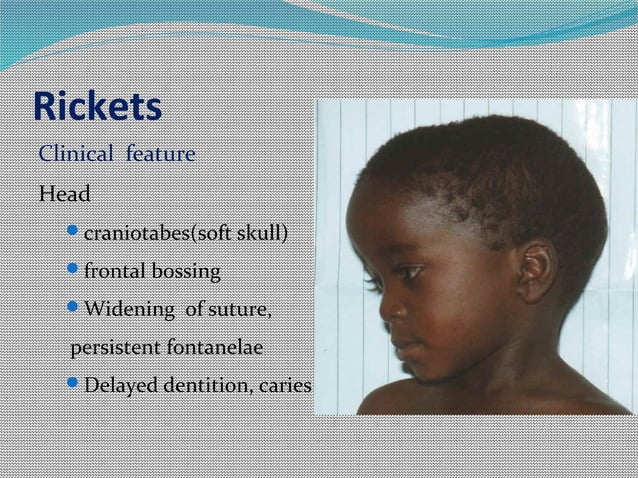 Rickets & osteomalacia | PPT