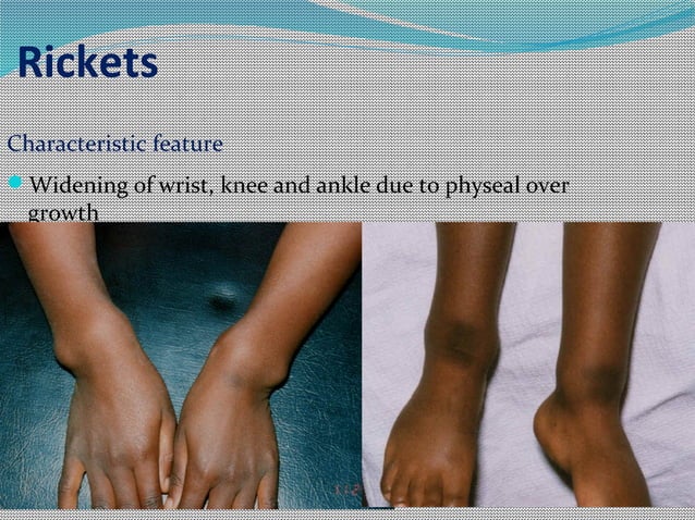 Rickets & osteomalacia | PPT