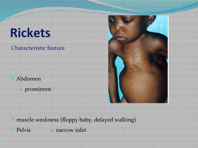 Rickets & osteomalacia | PPT
