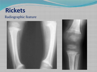 Rickets & osteomalacia | PPT