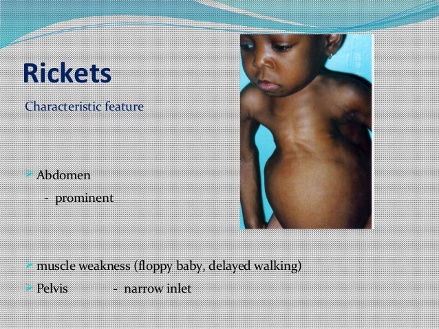 Rickets & osteomalacia