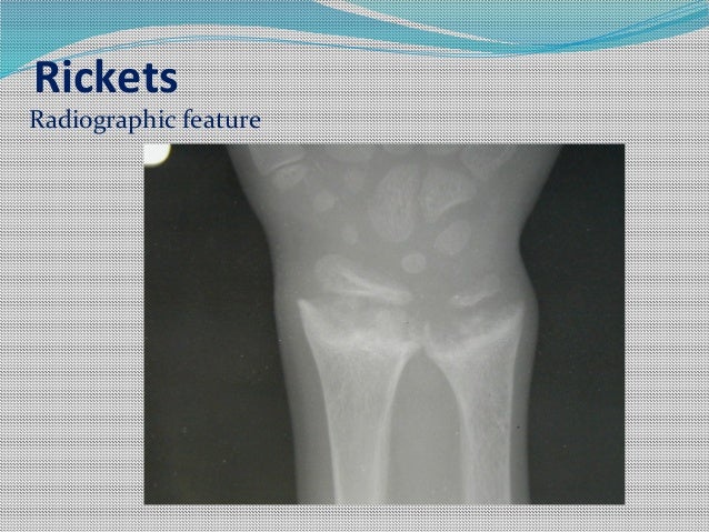 Rickets & osteomalacia
