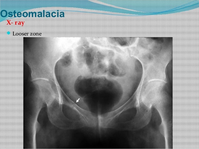 Rickets & osteomalacia