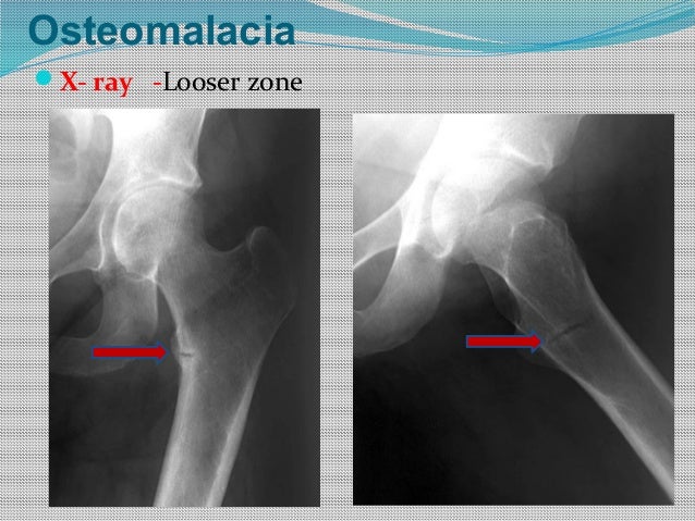 Rickets & osteomalacia