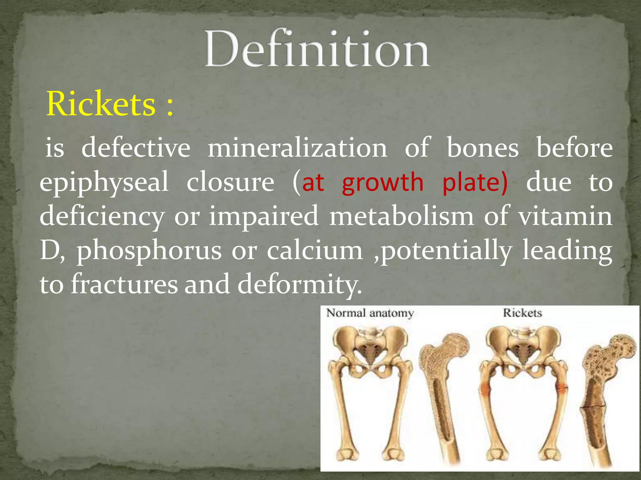 Rickets and osteomalacia | PPTX