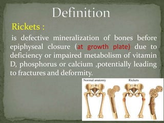 Rickets and osteomalacia | PPTX