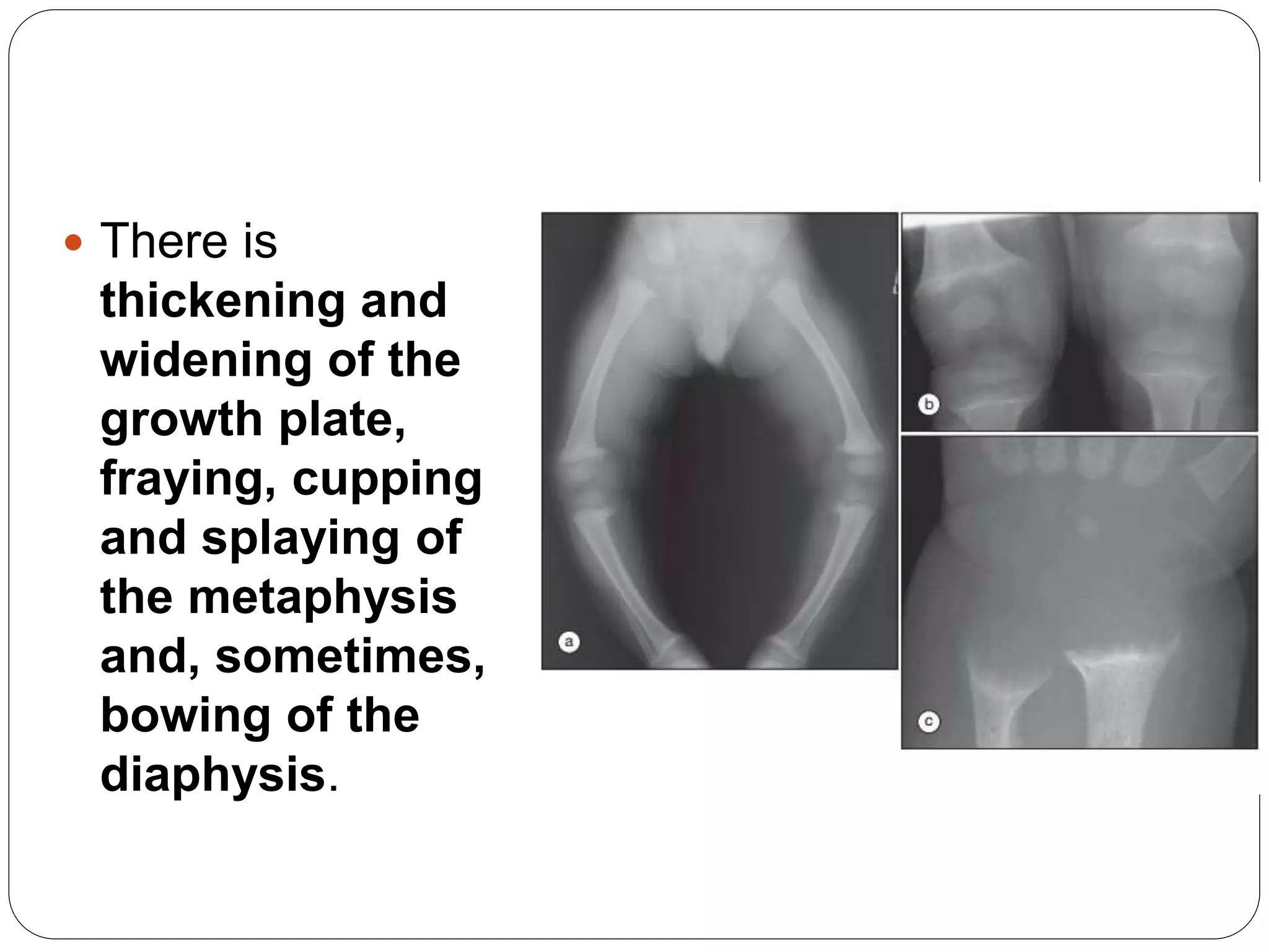 Rickets & osteomalacia | PPTX