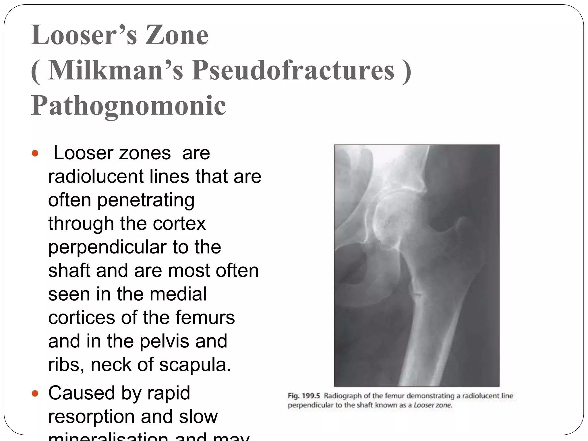Rickets & osteomalacia | PPTX