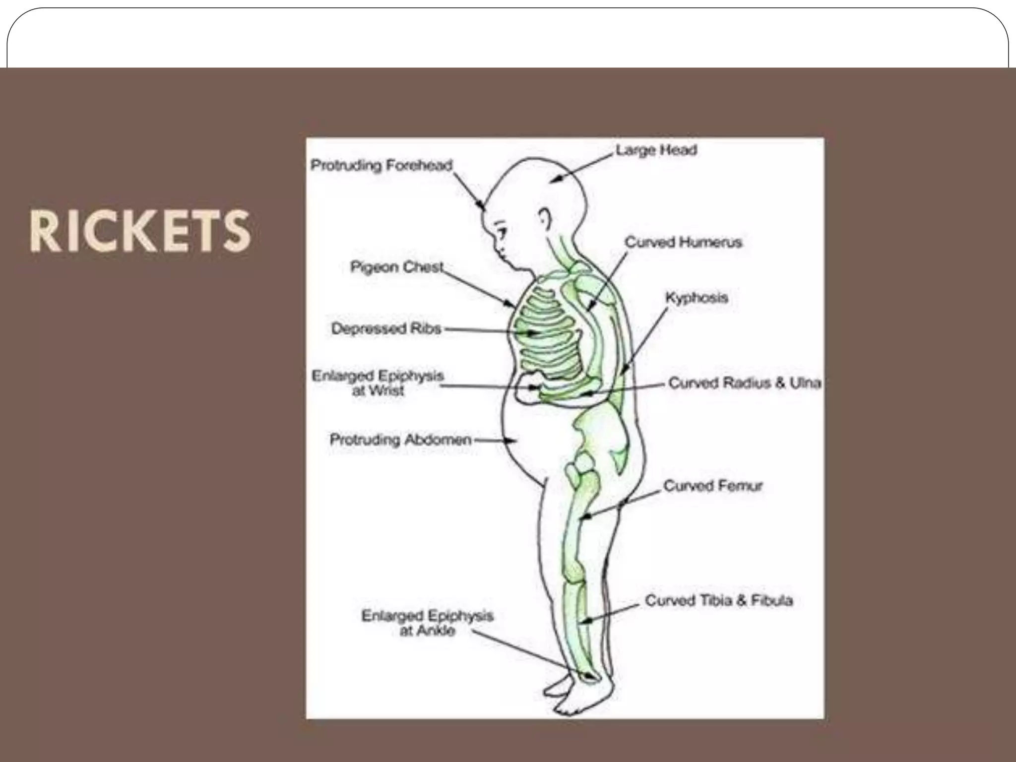 Rickets & osteomalacia | PPTX