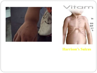 Rickets & osteomalacia | PPTX