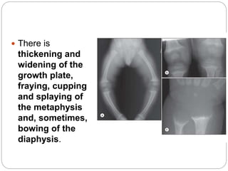 Rickets & osteomalacia | PPTX