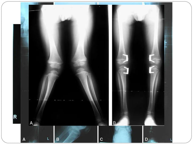 Rickets & osteomalacia | PPTX | Bone and Joint Conditions | Diseases ...