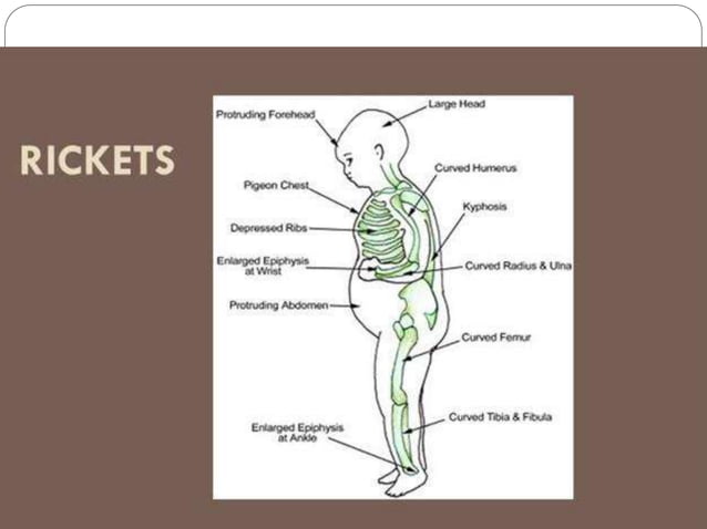Rickets & osteomalacia | PPTX | Bone and Joint Conditions | Diseases ...