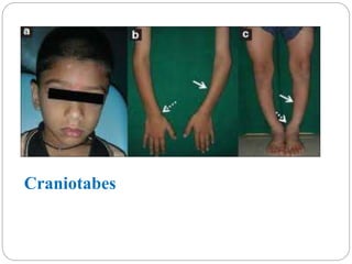 Rickets & osteomalacia | PPTX