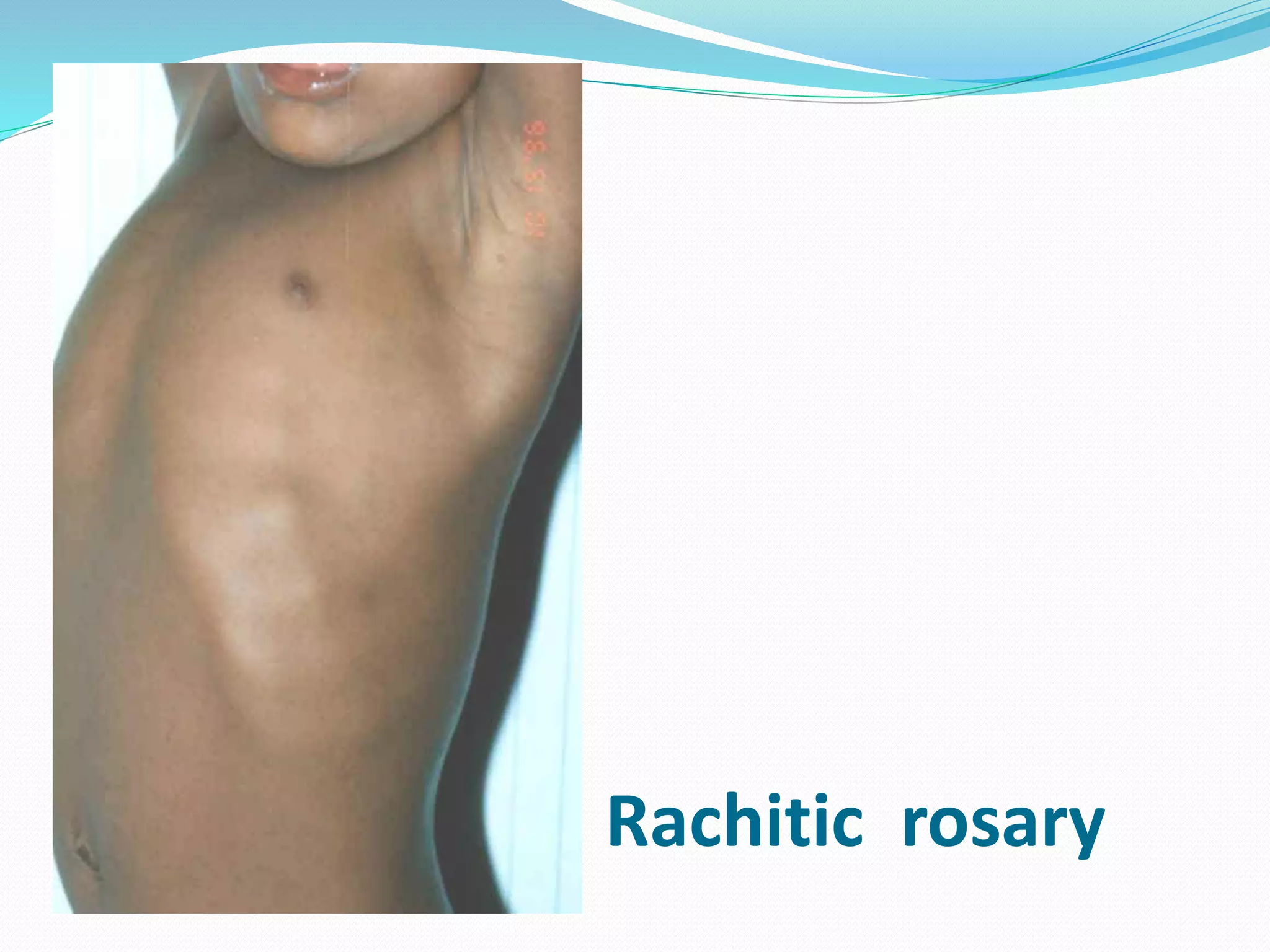 Rickets & osteomalacia | PPTX