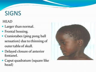 Rickets & osteomalacia | PPTX
