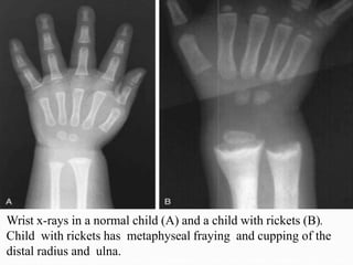 Rickets & osteomalacia | PPTX