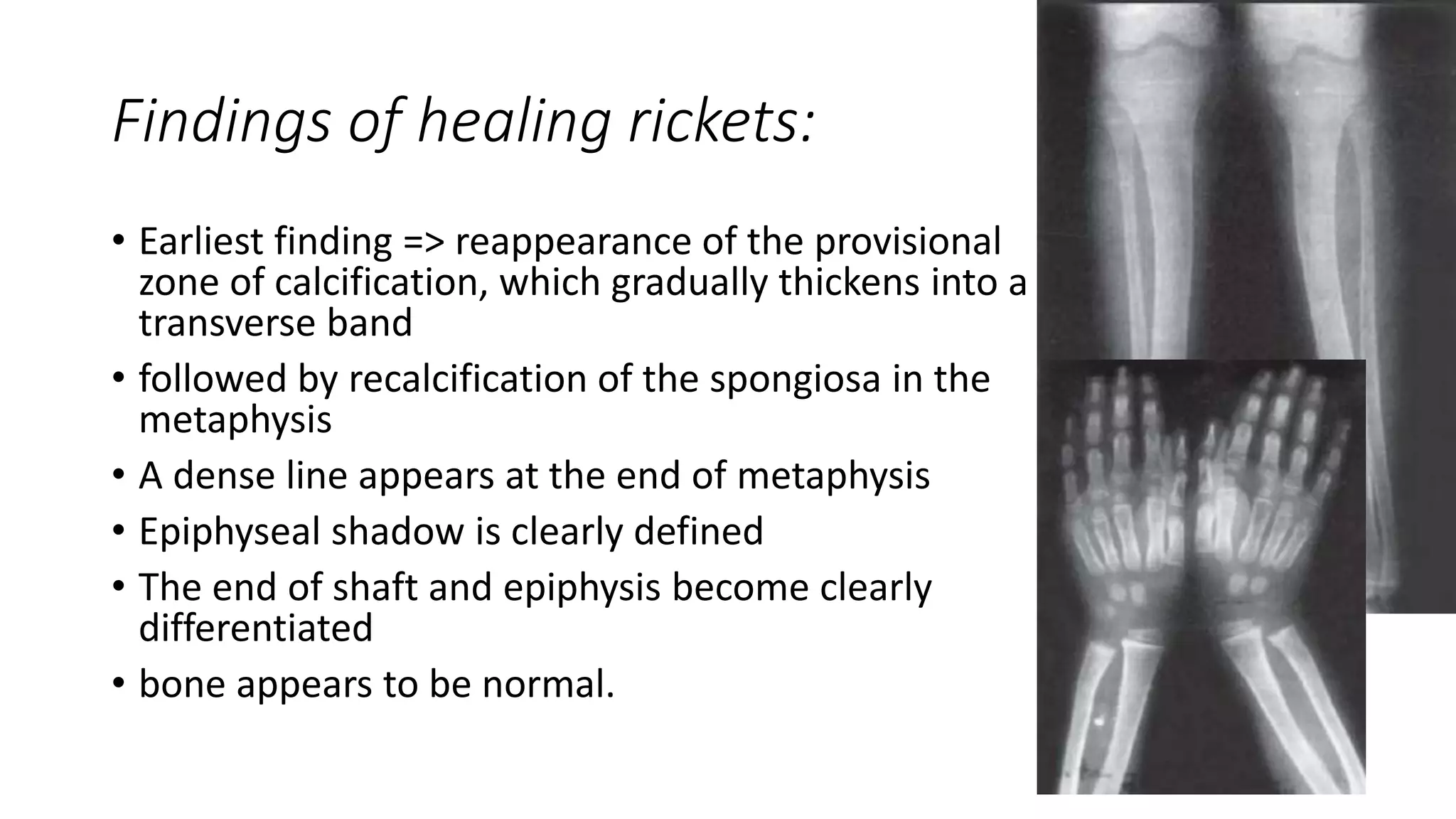 Rickets & Osteomalacia.pptx