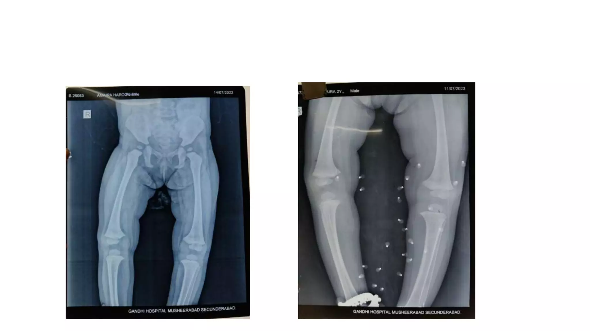 RICKETS & OSTEOMALACIA.pptx