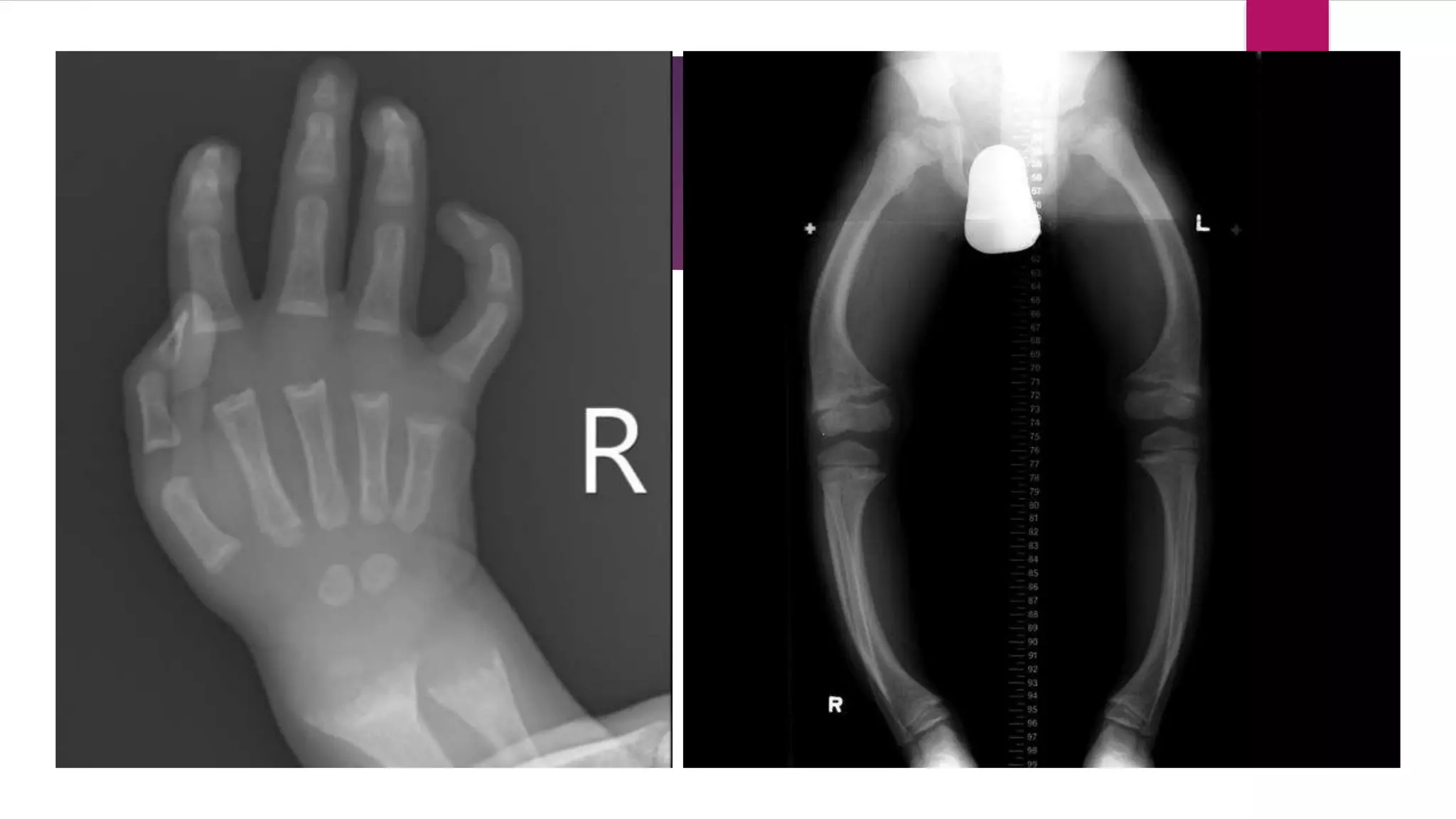 rickets & osteomalacia (1).pptx