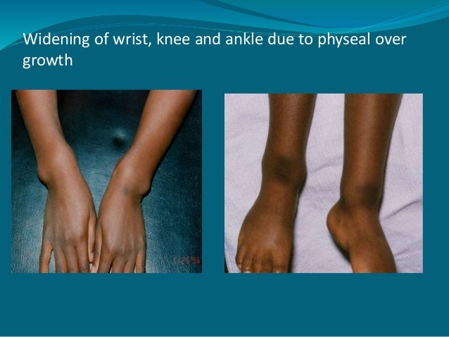 Rickets presentation