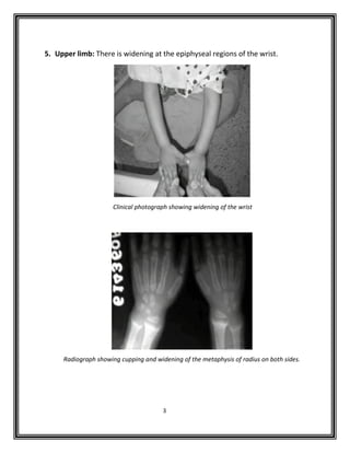 Rickets Rehabilitation program | PDF