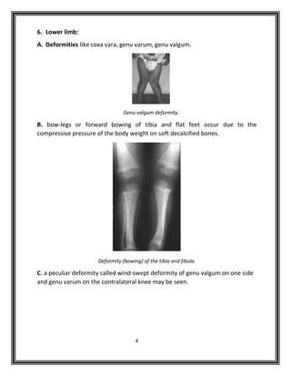 Rickets Rehabilitation program | PDF
