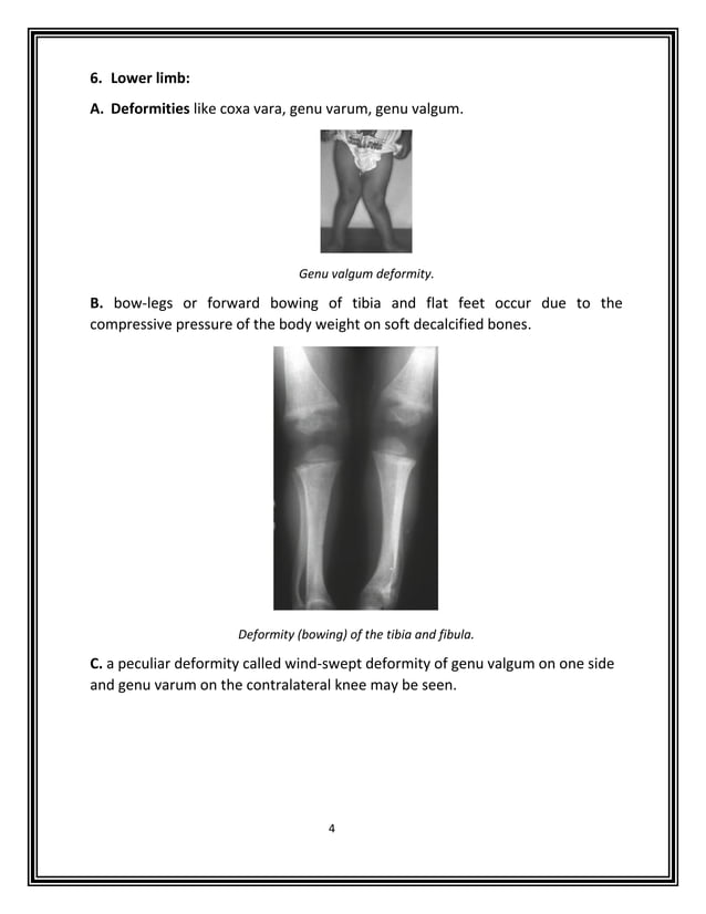 Rickets Rehabilitation program | PDF | Bone and Joint Conditions ...