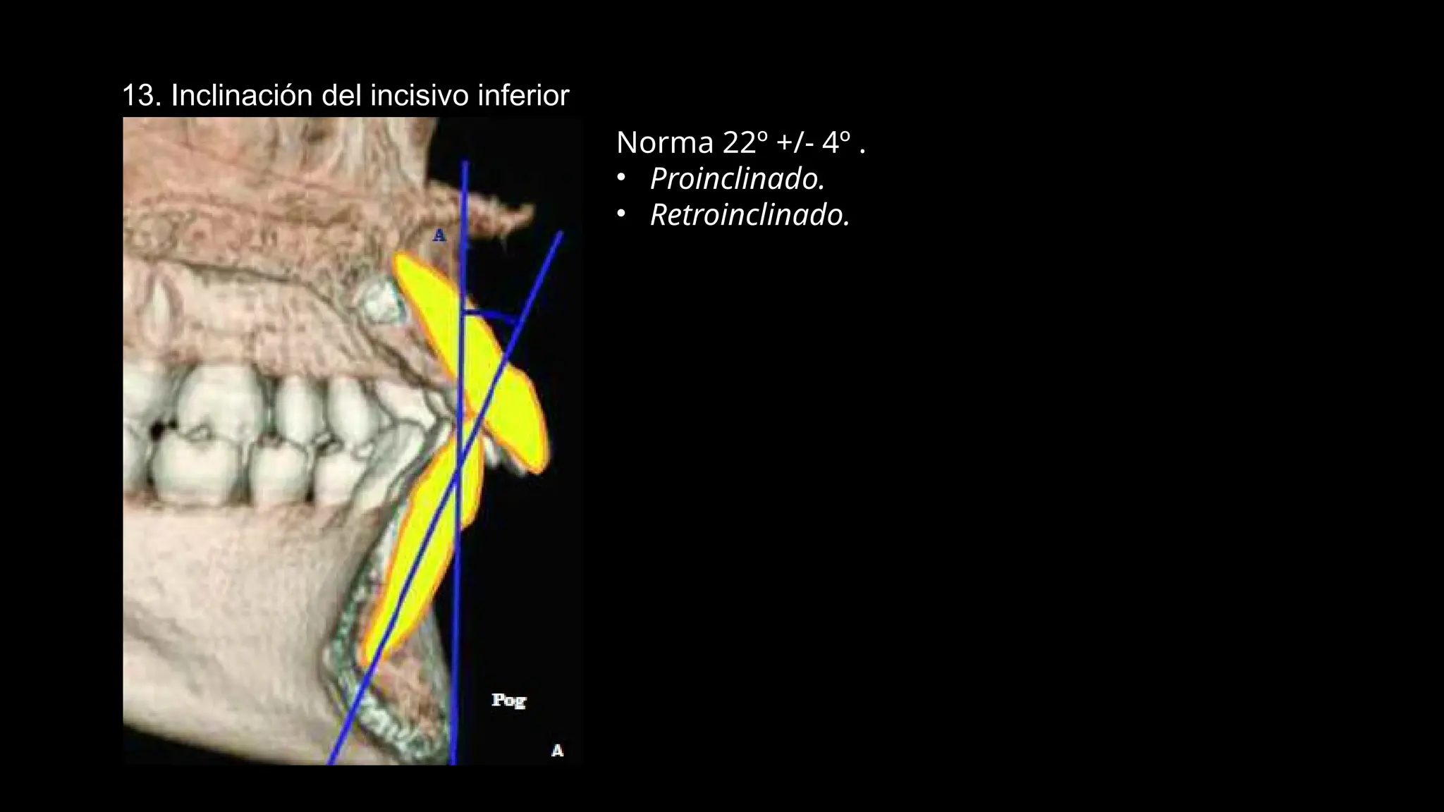 Analisis de Cefalometría de RICKETTS y ricketts simplificado | PPTX