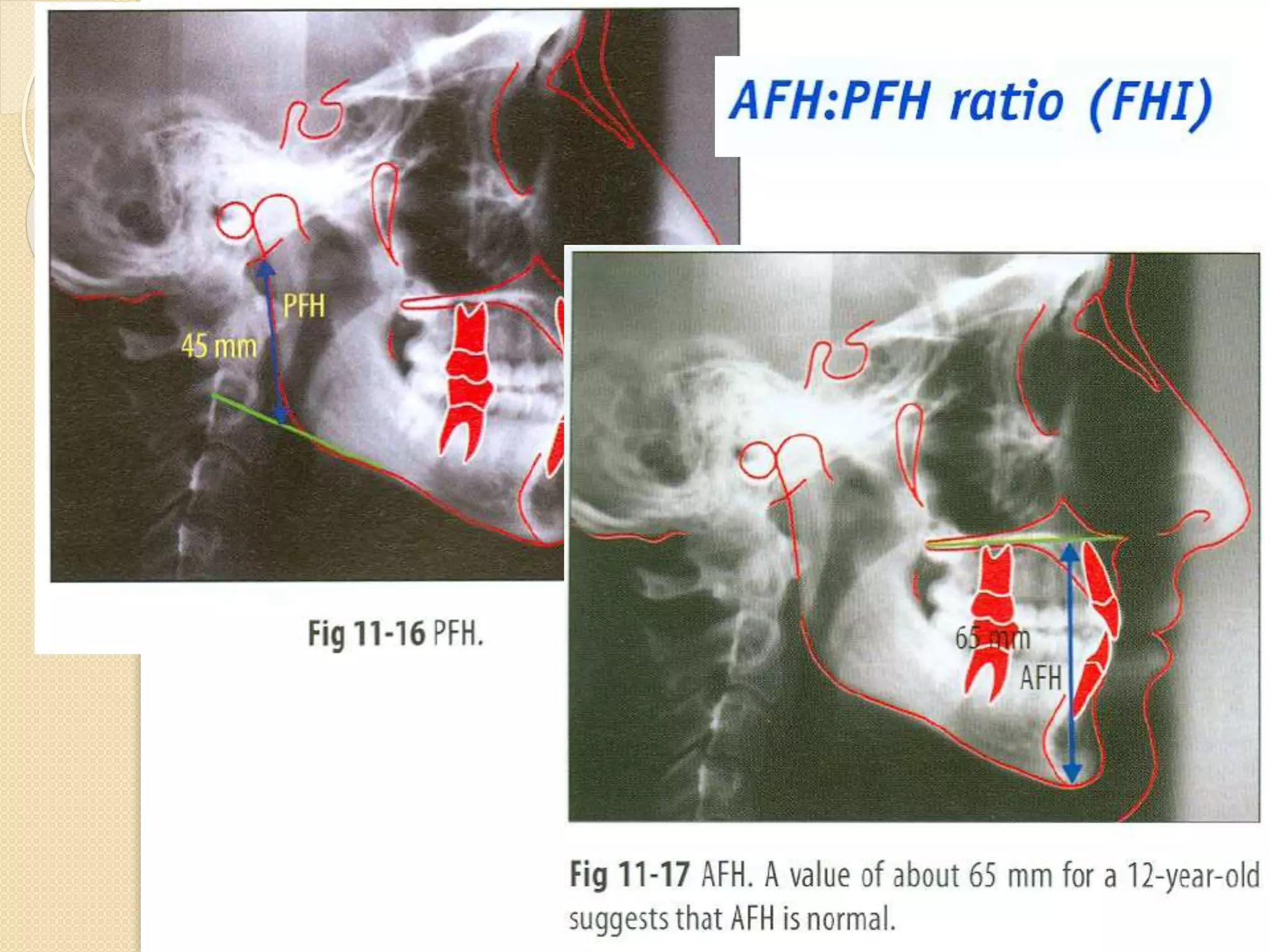 Ricketts analysis | PPTX