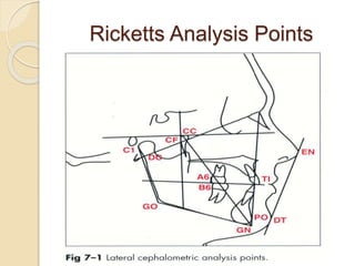 Ricketts analysis | PPTX