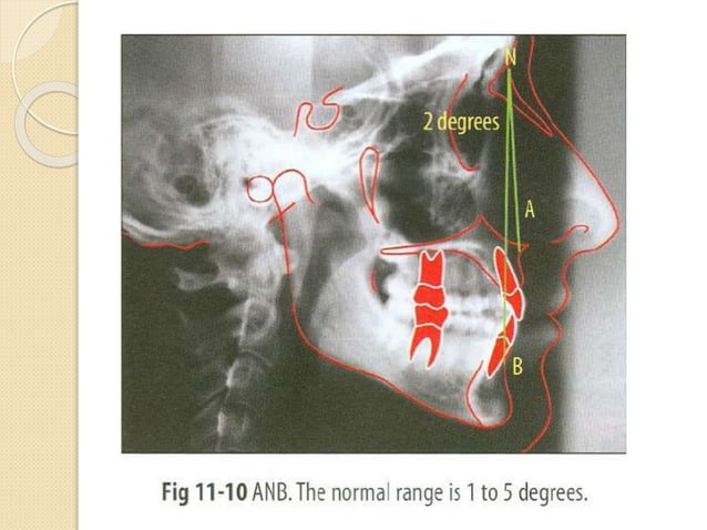 Ricketts analysis | PPTX