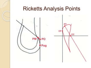 Ricketts analysis | PPTX