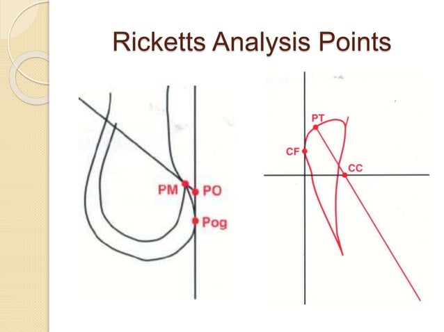 Ricketts analysis | PPTX