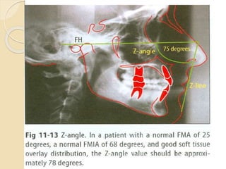 Ricketts analysis | PPTX