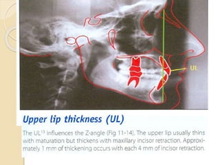 Ricketts analysis | PPTX