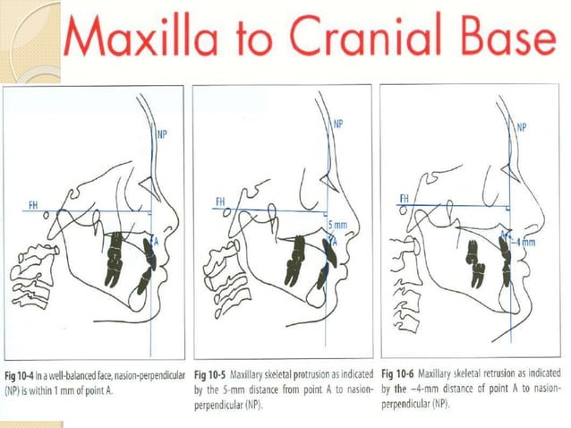 Ricketts analysis | PPTX
