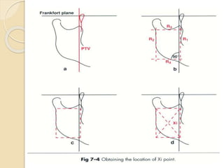 Ricketts analysis | PPTX