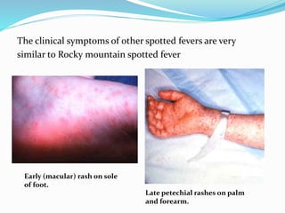 Rickettsia Rickettsii Rash