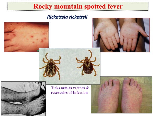 Rickettsial Diseases | PPTX | Infectious Diseases | Diseases and Conditions