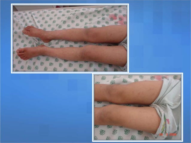 Rickettsial diseases