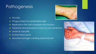 Rickettsia rickettsii presentation | PPTX